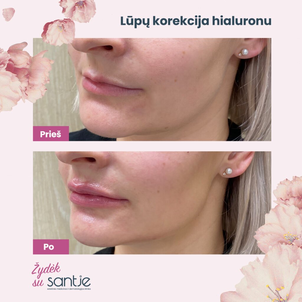 Lūpų formos ir apimties korekcija hialurono rūgšties užpildais